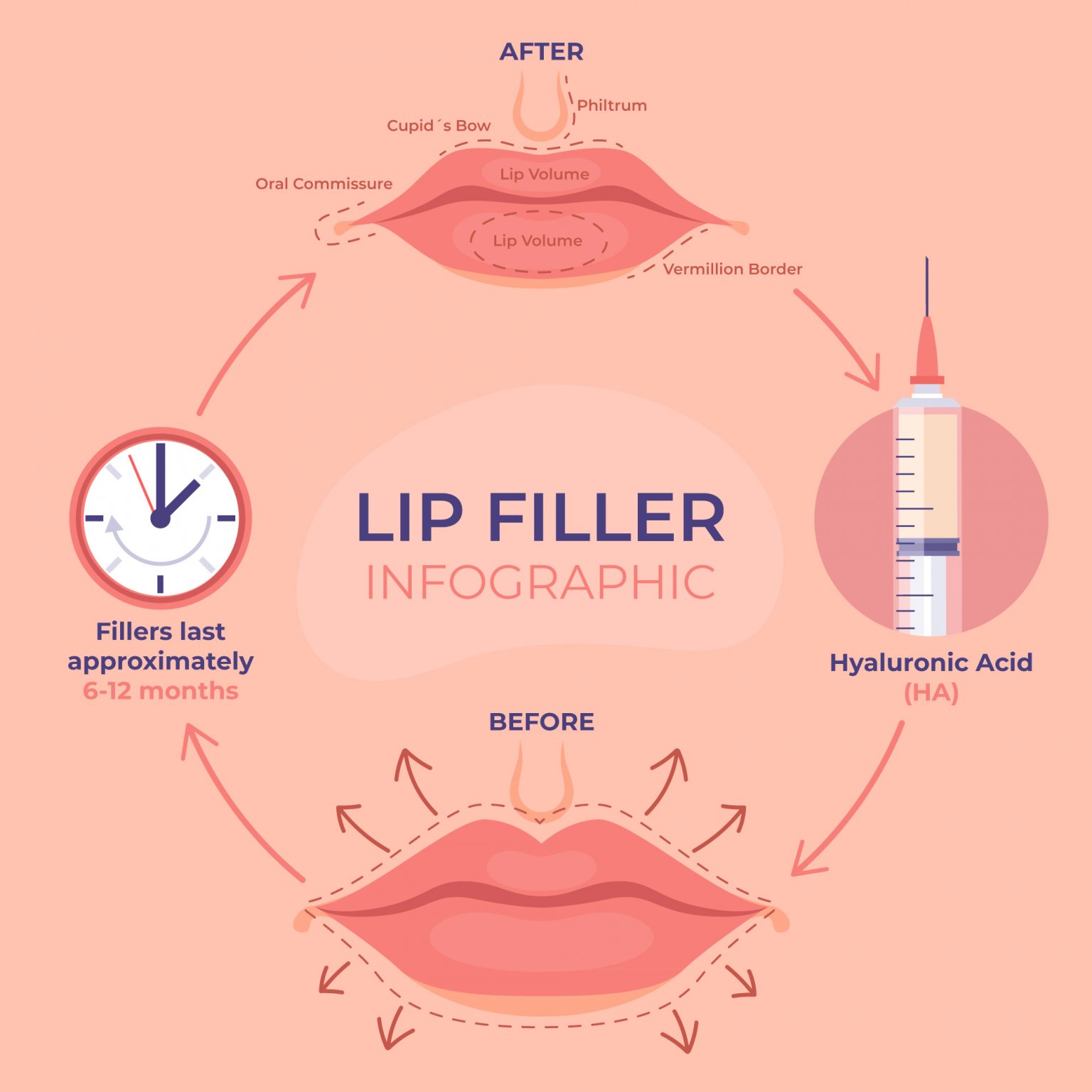 Lip Filler Swelling Stages: Here's What To Expect! | CelebrityStyleGuide